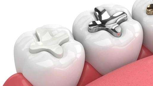 Are Metal Fillings Safe? The Amalgam Debate Explained | Preventative ...